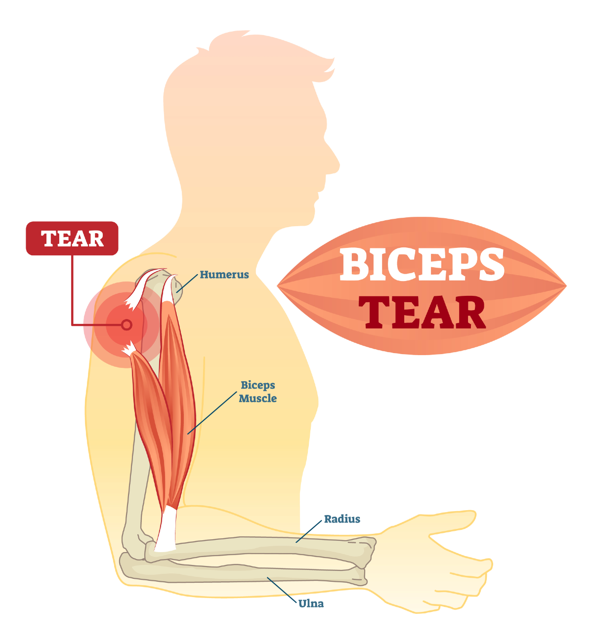 Biceps Tear | Indiana Slip & Fall Lawyers | Shaw Law