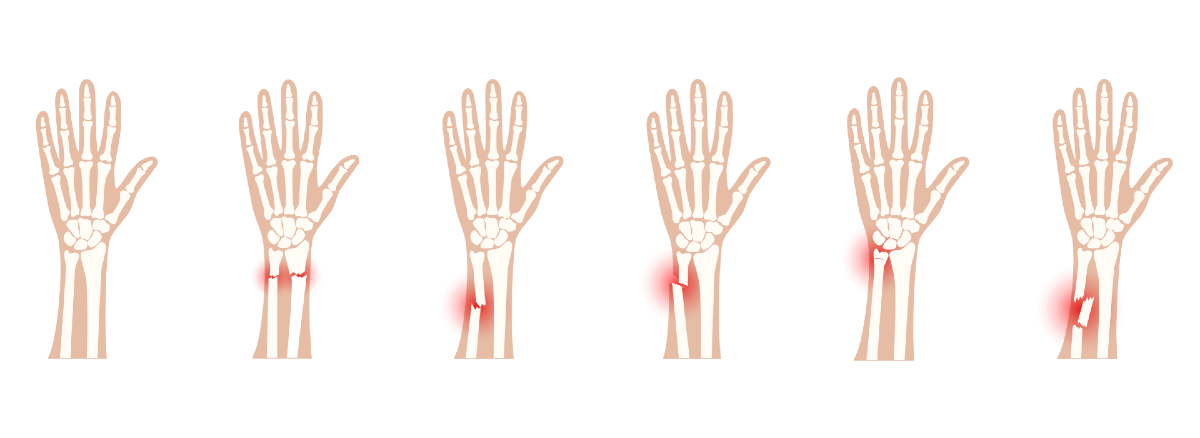 Broken Wrist Injuries | Indiana Slip & Fall Lawyers