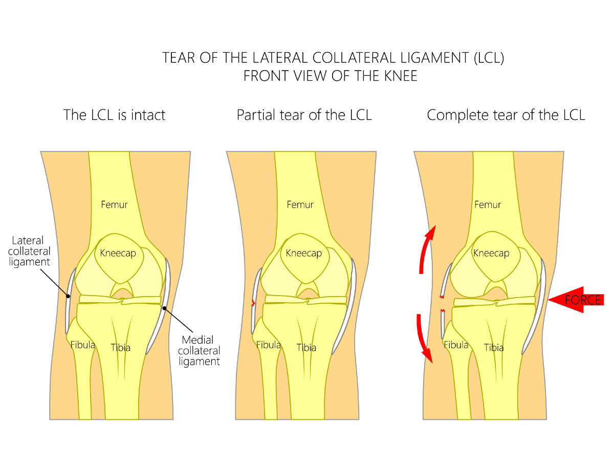 LCL Tear | Indiana Slip & Fall Lawyers | Shaw Law